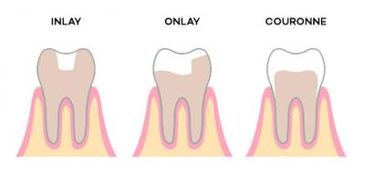 Les Inlay / Onlay Brest (29200) | Dentiste Cabinet dentaire du Questel